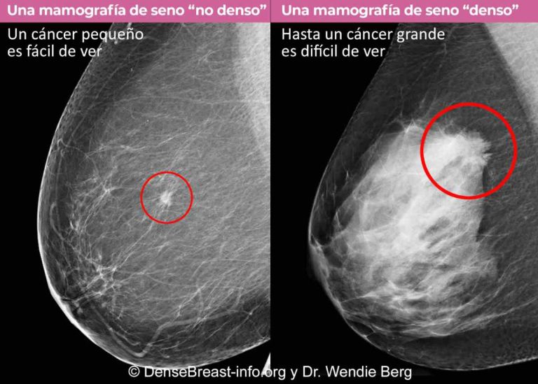 Cáncer de mama: especialistas recomiendan mastografías después de los ...